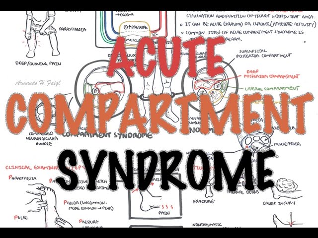 Compartment Syndrome - Overview - 2025