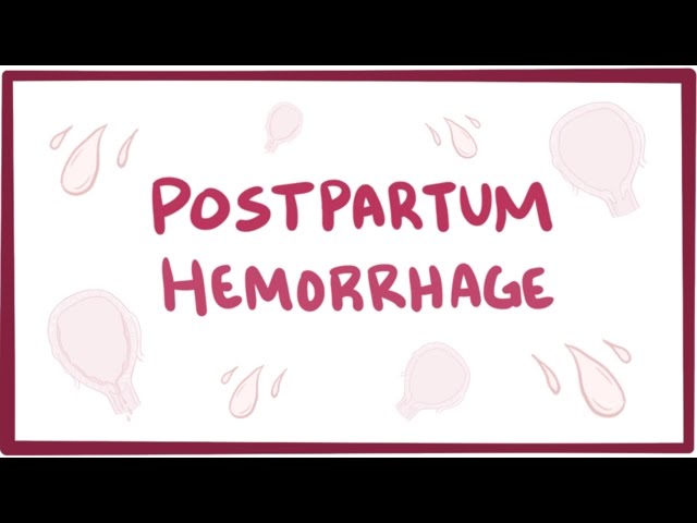 Postpartum Hemorrhage - Causes, Symptoms, Treatment, Pathology - 2023 Postpartum Hemorrhage - Causes, Symptoms, Treatment, Pathology - 2023