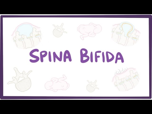 Spina Bifida (myelomeningocele, Meningocele, Occulta) - Causes ... Spina Bifida (myelomeningocele, Meningocele, Occulta) - Causes ...