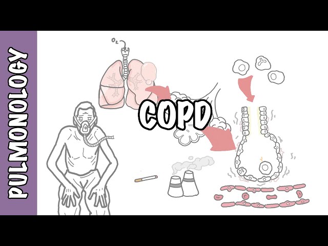 Understanding COPD - Chronic Obstructive Pulmonary Disease Cause ...